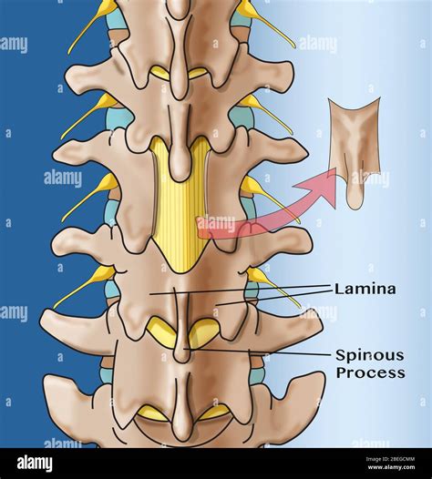 What Is A Micro Laminectomy At Nicholas Dahlke Blog