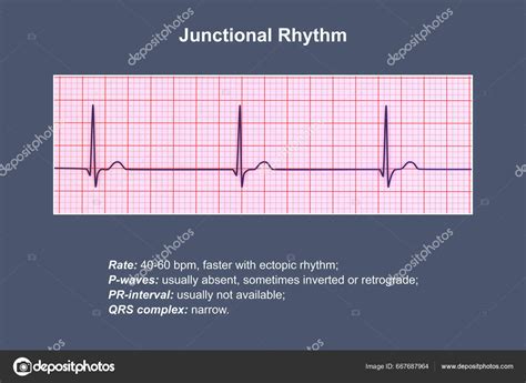 Junctional Rhythm