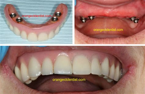 Implant Supported Dentures Dentist Orange Woodbridge New Haven Ct