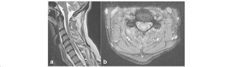 Sagittal T2 Weighted Image A And Axial Gradient Recalled Echo Gre