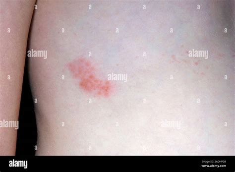 Shingles Rash On The Chest Of A 4 Year Old Boy Shingles Is A Disease