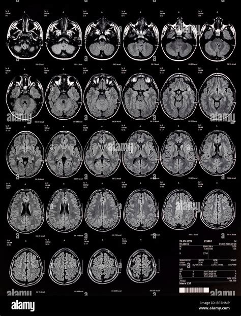 Brain Mri