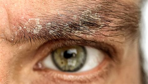 Eyebrow Dandruff Treatment Effective Solutions For Flaky Brow