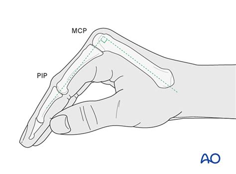 Nonoperative Treatment For Dislocation Of The Proximal Interphalangeal Joint