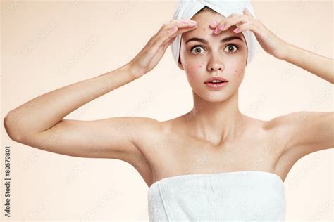 Girl Squeezing Her Pimples Removing Pimple From Her Face Stock Photo Adobe Stock
