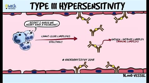 Type Iii Hypersensitivity Immune Complex Disease In 2025