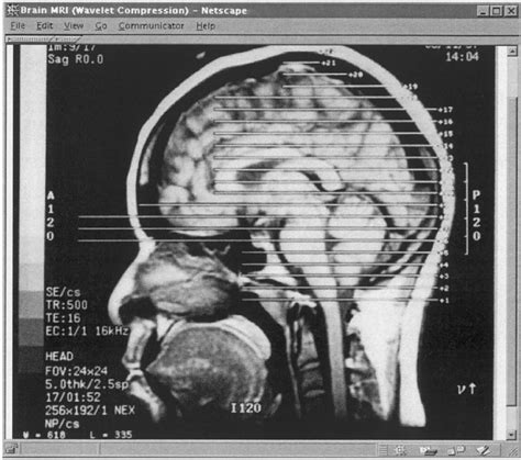 A Presentation Of A Wavelet Compressed Brain Mri Image Size 768 × Download Scientific