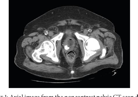 Figure 1 From Dystrophic Calcification Of The Prostate After Cryotherapy Semantic Scholar