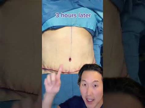 How Much Is Plastic Surgery To Remove Loose Skin