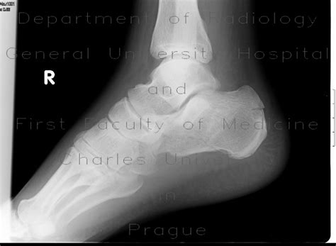 Radiology Case Comminuted Fracture Of Calcaneus