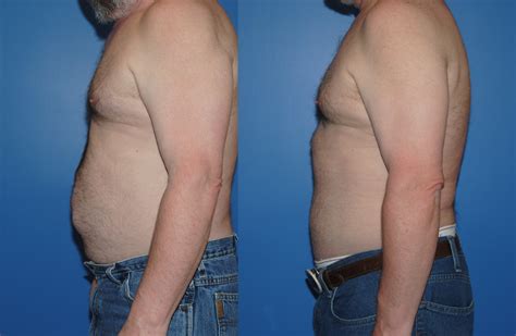 Hernia Repair And Abdominal Wall Reconstruction May 2014