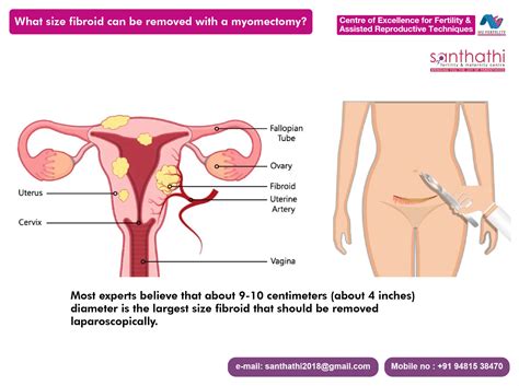 What Size Fibroid Can Be Removed With A Myomectomy Artofit