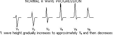 Poor R Wave Progression New Health Advisor