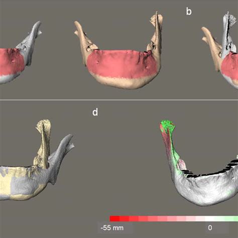 Cases Demonstrating The High Variability Of Mandibular Shape Asymmetry Download Scientific