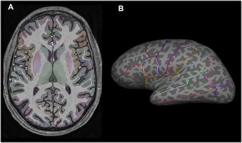 Example Of A Successfully Completed Freesurfer Recon All Stream At Download Scientific Diagram