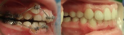 Orthodontics Happydent