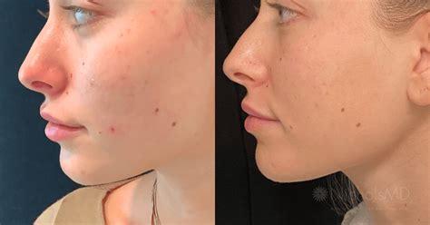 What Are Vampire Facial And Prp Treatments—expert Tips Allure
