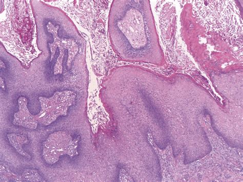 Cutaneous Verrucous Carcinoma The Exophytic Component Present Download Scientific Diagram