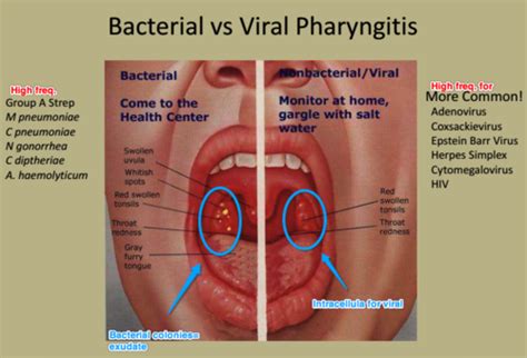 Gonorrhea Vs Strep Throat