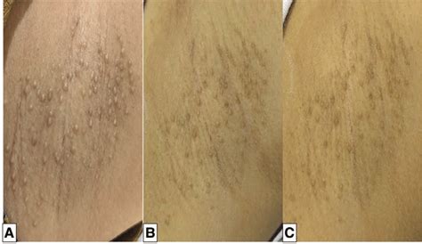 Physical Examination Of The Left Axilla Before And After Btx A