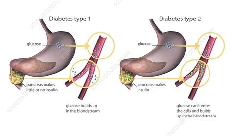Type 1 Diabetes Diagram Pathophysiology Of Type 1 Diabetes And Gut