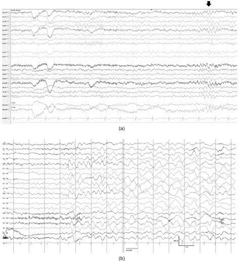 Eeg In Focal And Generalized Epilepsies Pearls And Perils Epilepsy