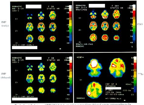 Figure 2 From Evaluation Of Cerebral Hemodynamics In Avms Using Spect Semantic Scholar