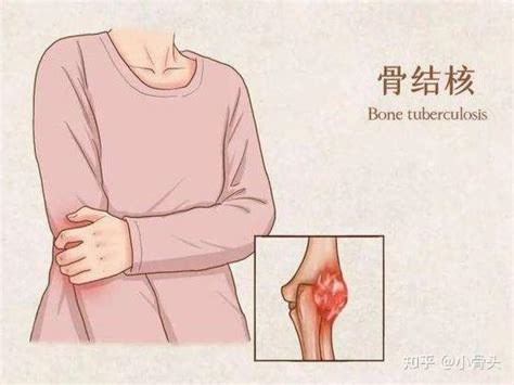 骨结核的类型有哪些？ 知乎