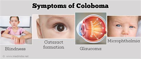 Coloboma Causes Symptoms Diagnosis Treatment And Prevention