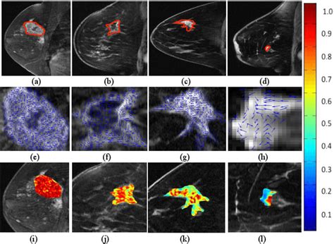Collage Entropy Maps On Breast Cancer Cases 2d Dce Mri 15 Tesla