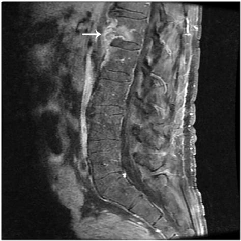 Gadolinium Enhanced T1 Weighted Mri Of The Lumbar Spine Showing