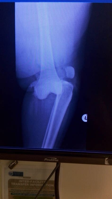 Xray Of Dislocated Knee Rmedizzy