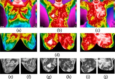 Artificial Intelligence As A Diagnostic Tool In Breast Cancer Thermography By Manny Movahedi