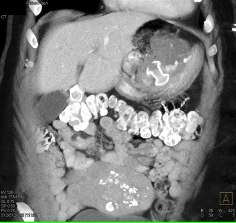 Cystogastrostomy Tube Stomach Case Studies Ctisus Ct Scanning