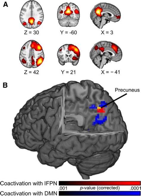 Precuneus Is A Functional Core Of The Default Mode Network Pmc