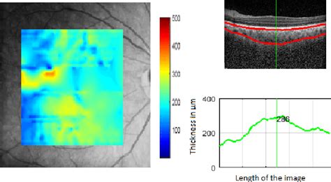 Figure 4 From Oct Segmentation Using Convolutional Neural Network