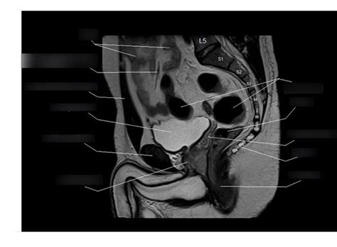Diagram Of Sagittal Male Pelvic Organs Mri Quizlet
