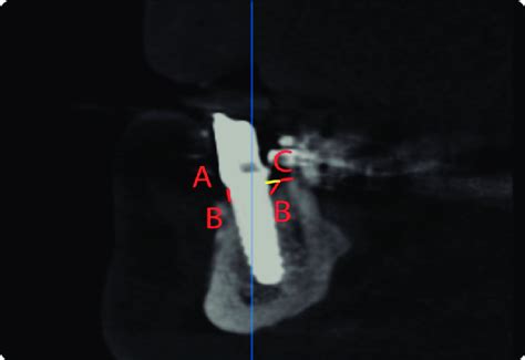 The Measurement Of Buccal And Lingual Vertical And Horizontal Bone Loss Download Scientific