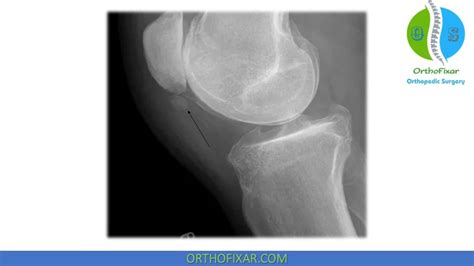 Patella Spur