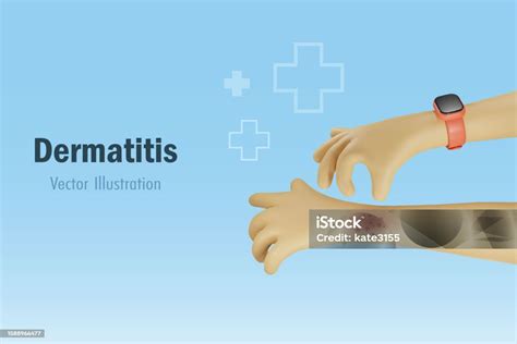 피부염 알레르기 및 의료 피부 문제 가려운 팔을 손으로 긁는다 의료 및 건강 관리 3d 벡터 상처에 대한 스톡 벡터 아트 및 기타 이미지 Istock