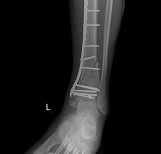 Tibial Pilon Fracture Treatment Private Surgeon London London Foot And Ankle