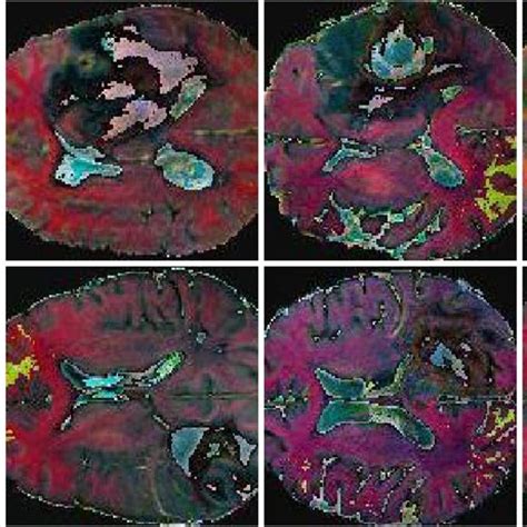 Brain Tumor Computer Vision Dataset Kaggle