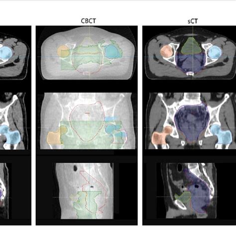 Visual Comparison Of CT CBCT And SCT Images Of One Patient The HU Download Scientific