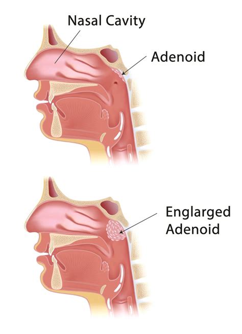 Enlarged Adenoids Treatment Without Surgery Natural Remedy