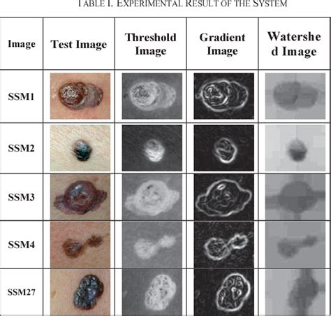 Table I From An Automatic Segmentation Of Skin Lesion From Dermoscopy Images Using Watershed