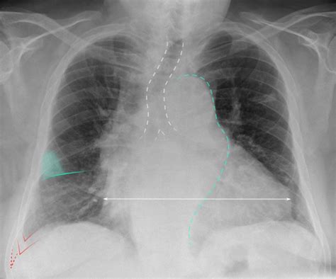 Chest X Ray Pulmonary Embolism