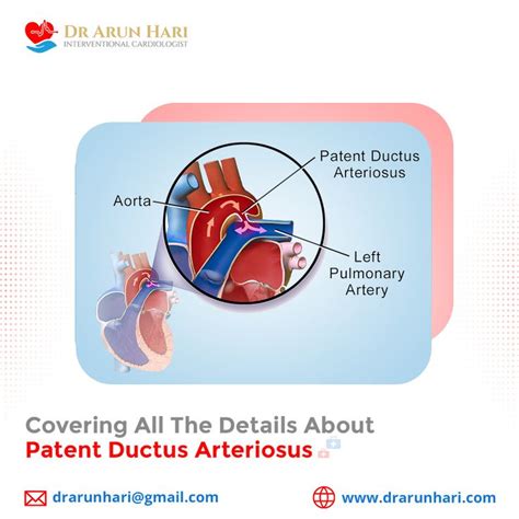 Covering All The Details About Patent Ductus Arteriosus Ductus