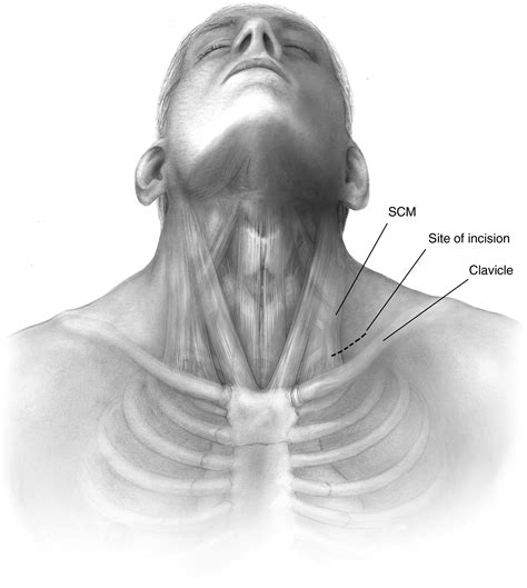 Supraclavicular First Rib Resection Operative Techniques In Thoracic