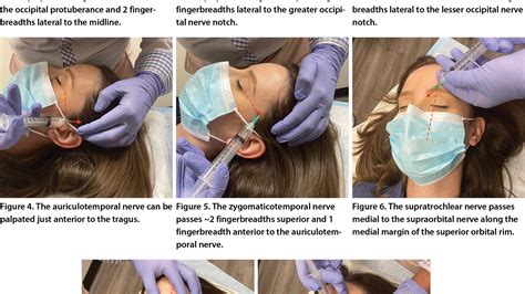 Non Botulinum Toxin Injections For Headache—current Evidence