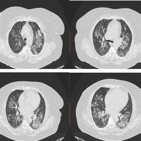 Current Presentation Ct Scan In Upper Lobes Asymmetric Centrilobular